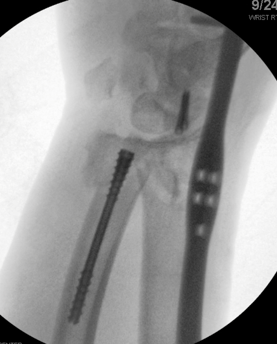 NX Nail fixation of distal ulna fracture in high energy wrist injury.